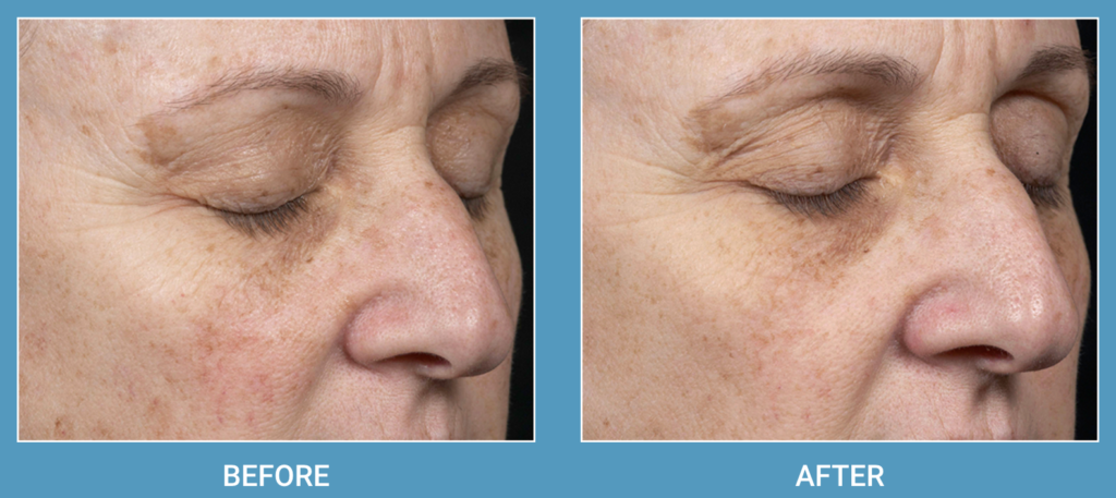 Clear + Brilliant® Laser Miami, FL | Aventura Clear + Brilliant®