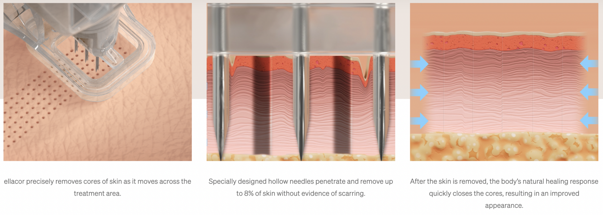 Ellacor® in Miami, FL | Aventura Ellacor®